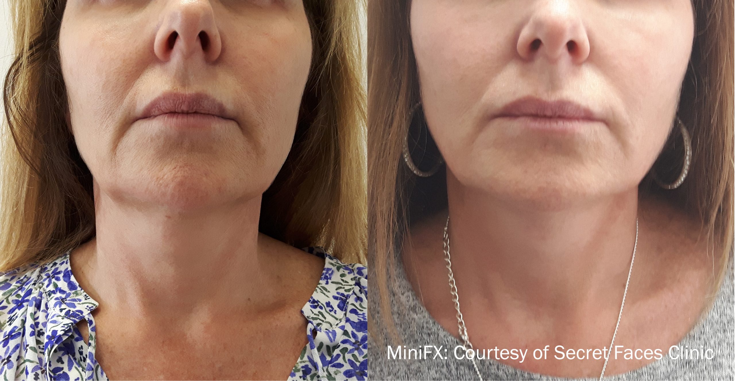 INMODE | BodyFx / MiniFx