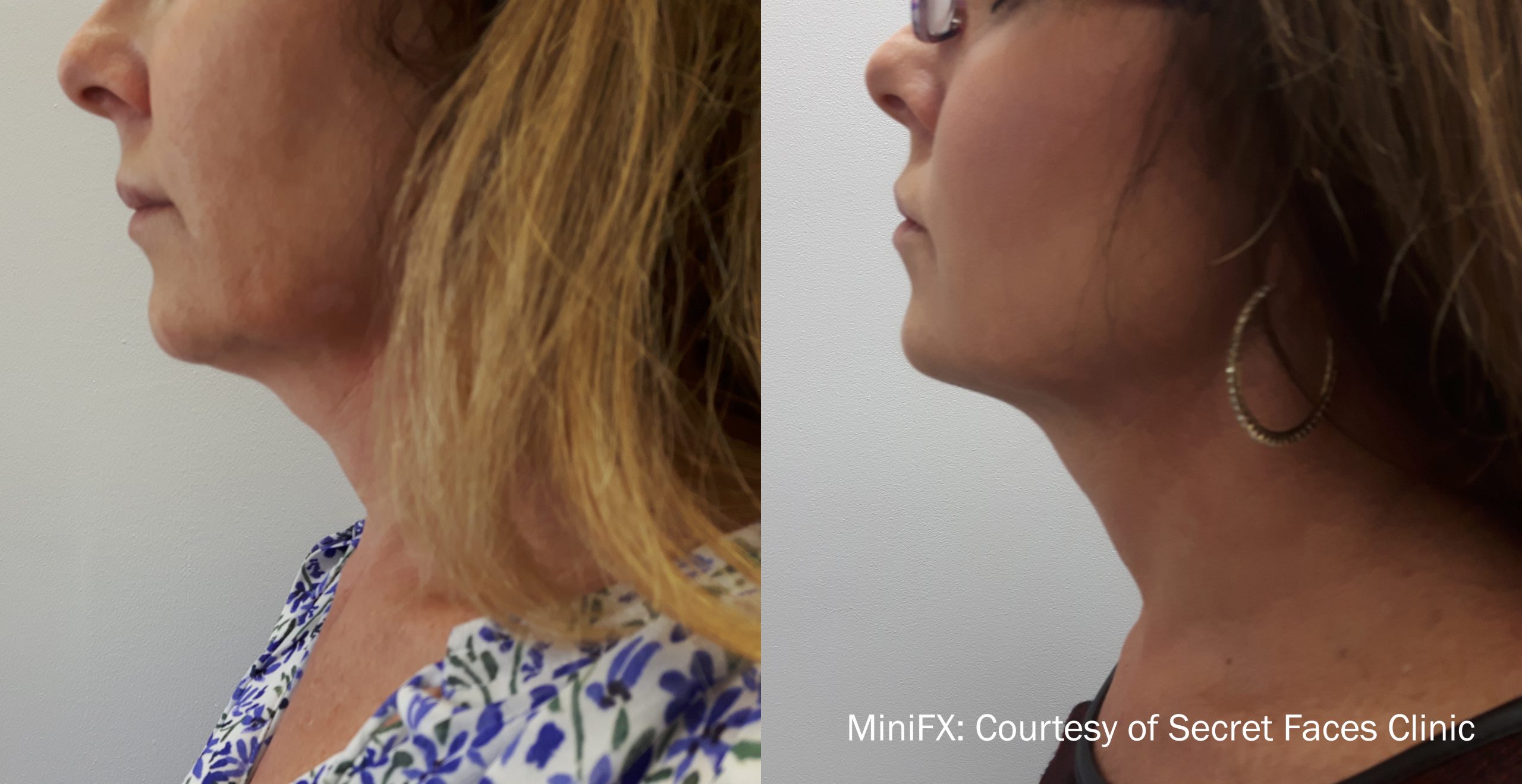 INMODE | BodyFx / MiniFx