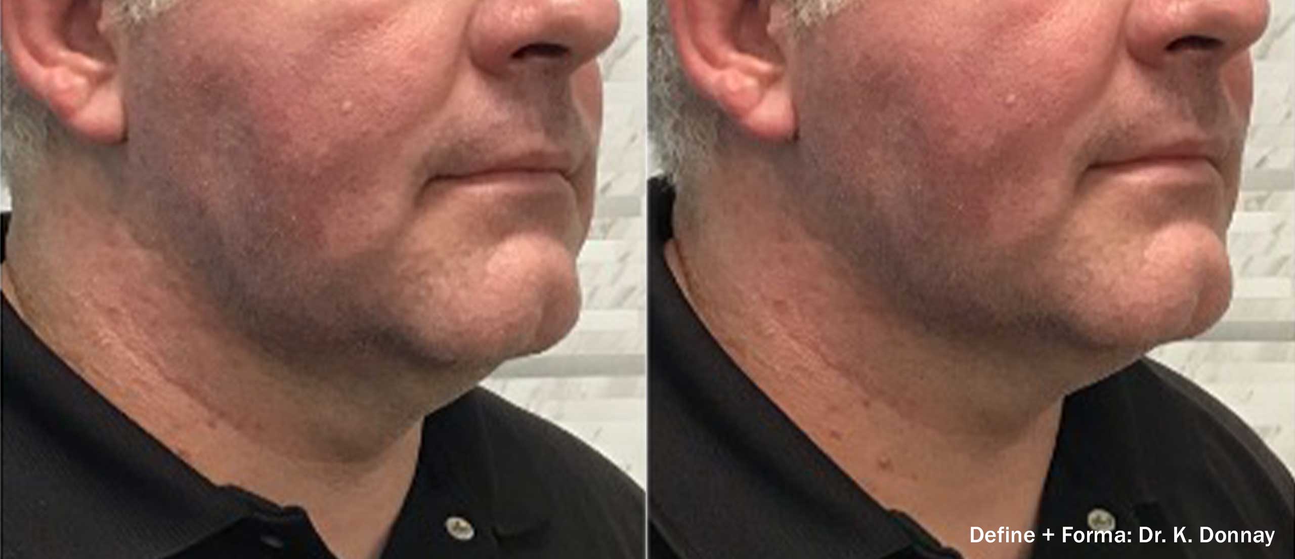 INMODE | DefineCheek / DefineChin