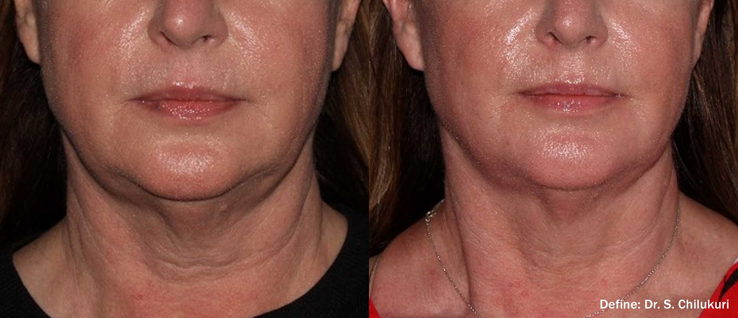 INMODE | DefineCheek / DefineChin