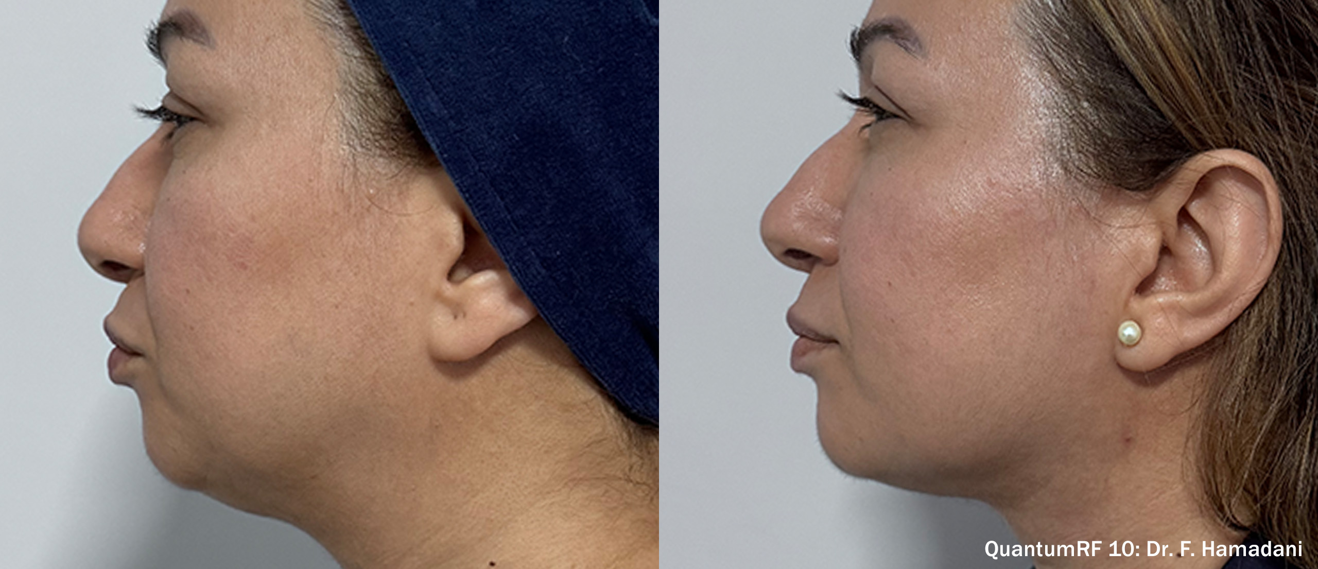 QuantumRF 1 | INMODE