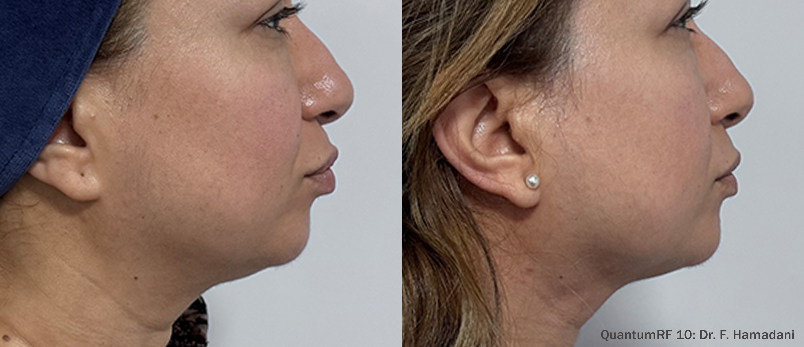 QuantumRF 2 | INMODE